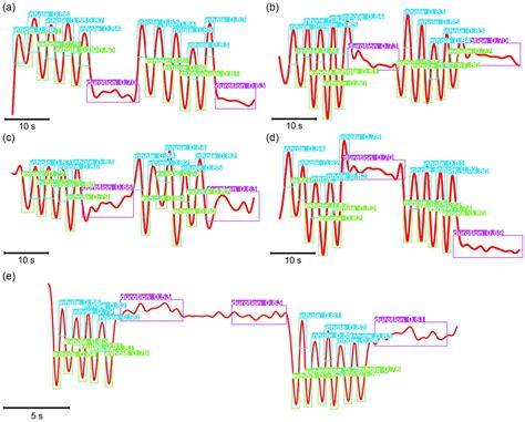 A Wearable Device Integrated With Deep Learning‐based Algorithms For