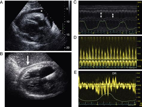 Pericarditis Echo