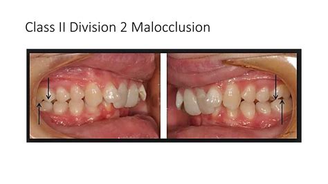 Management Of Class Ii And Iii Malocclusion Pptx