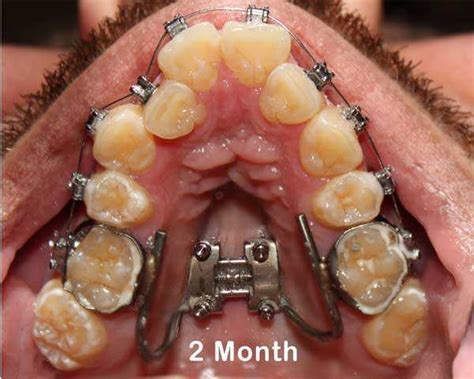 Marpe Sme As A Non Invasive Alternative To Sarpe Houston