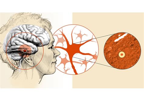 Clinical Features And Diagnosis Of Dementia With Lewy Bodies Nmsmjk