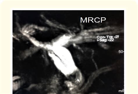 Mrcp Revealing Sickle Cell Cholangiopathy With Cbd Stone Arrow E Download Scientific