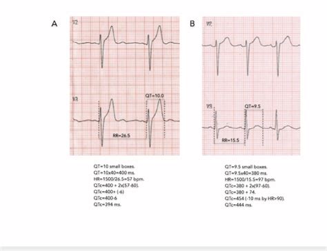 Examples Of How QT Was Measured And Corrected By HR Using The Proposed Download Scientific