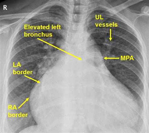 Biatrial Enlargement On Cxr La Border Seen Within Right Atrial Border