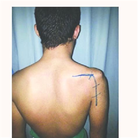 Intraoperative Picture Showing Musclucutanous Nerve Neurotization By Download Scientific