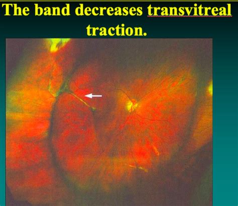 Rd Repair Vitrectomy And Erm Peel Flashcards Quizlet