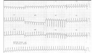 Supraventricular Tachycardia Svt Pptx