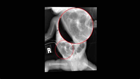 Necrotizing Enterocolitis Symptoms Necrotizing Enterocolitis
