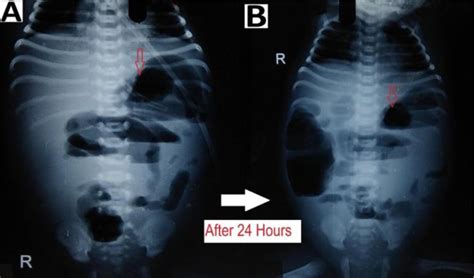 Preoperative Radiographs Showing A Dilated Bowel Loops Red Arrow Download Scientific