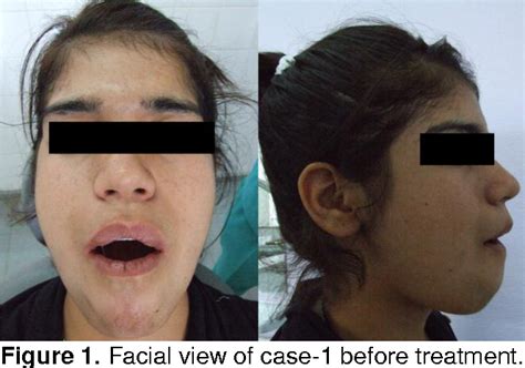 Figure 1 From Temporomandibular Joint Tmj Dislocation During Intubation And Dental Procedures