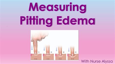 Pitting Edema Scale 1 4