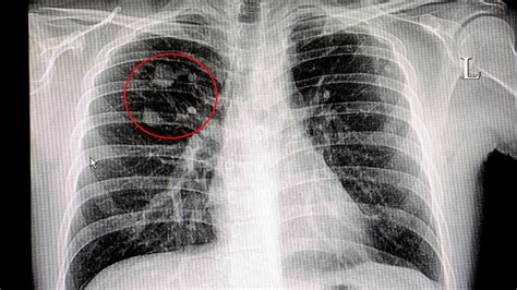 Rheumatoid Nodules Back Enthesitis And Enthesopathy Explained