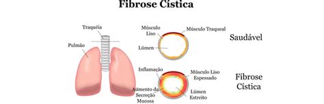 A Aplicação Do Tratamento Fisioterapêutico Na Fibrose Cística