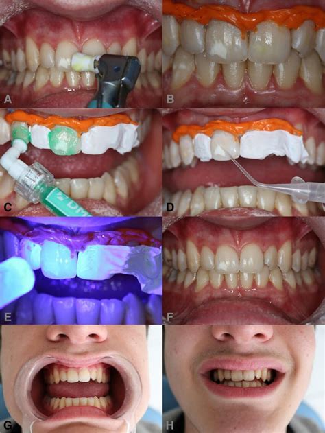 Resin Infiltration Steps At Buddy Byram Blog