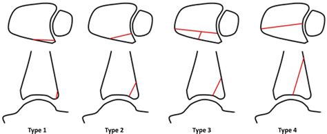 Oberes Sprunggelenk Putzbrunn Fraktur Klassifikationen