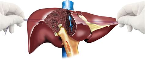 Hepatectomy Indications Technique And Complications