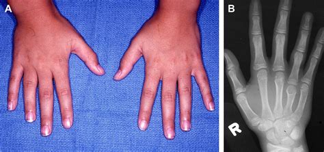 Undergrowth Brachydactyly Hand Clinics
