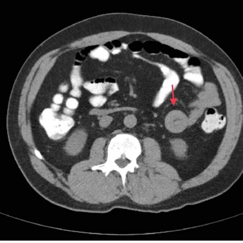 ct scan demonstrating the classical target sign morphology of