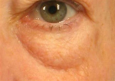 Puffy Lower Eyelid
