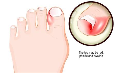 Ingrown Toe Nail Removal And Treatment Doctor Chicagoil