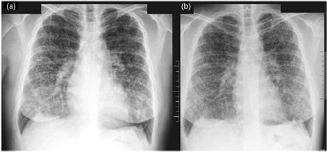 Plain Radiographs Showing A Diffuse Interstitial Infiltrates And B