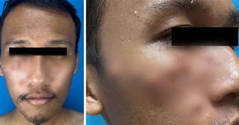 “성관계 후 얼굴 곳곳 혹 올라와” 20대 男… 충격 왜 이런 일이