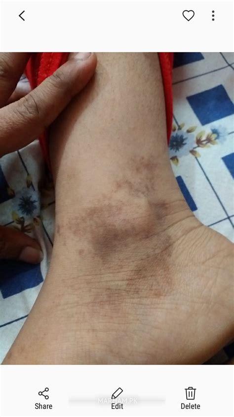 Random Brown Spots On Foot Outlet