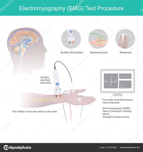 Electromyography Test Procedure Stock Vector Image By ©pattarawit 293813064