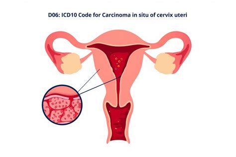 D06 Icd10 Code For Carcinoma In Situ Of Cervix Uteri