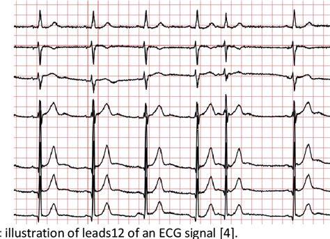 Figure 1 From Robust R Peak Detection Using Deep Learning Based On