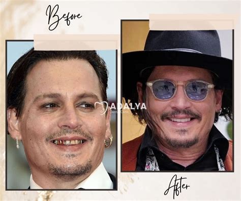 Johnny Depp Teeth New Rotting Before And After Teeth Journey