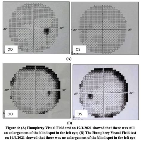 Unilateral Papilledema As A Rare Manifestation Of Cerebral Neurotoxoplasmosis In Hiv Patient