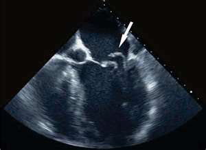 Echo II Midterm Images Flashcards Quizlet