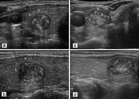 Normal Thyroid Ultrasound Colors
