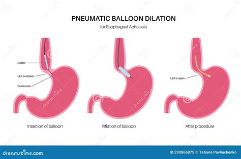 Endoscopy With Dilation At Lester Mitchell Blog