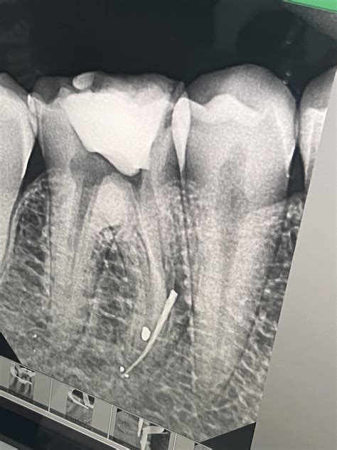 How Long Should It Take To Remove A Broken File During A Root Canal Raskdentists