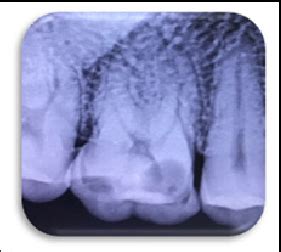 Case Preoperative Radiograph Download Scientific Diagram