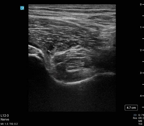 Peng Nerve Block Emergency Medicine Training Peng Nerve Block Emergency Medicine Training