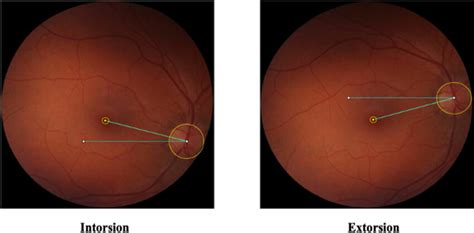 Examples Of Dfa Measurement For Right Eye Showing Intorsion And