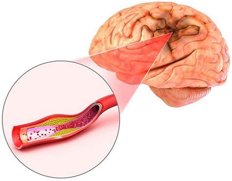 Co Byste Měli Vědět O Ateroskleróze Zdravestravovanieu