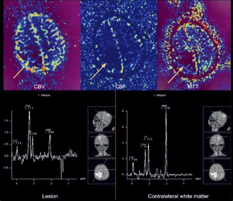 Magnetic Resonance Mr Perfusion Weighted Imaging Top Row Download Scientific Diagram
