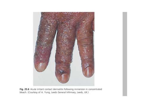 Irritant Contact Dermatitis Pptx
