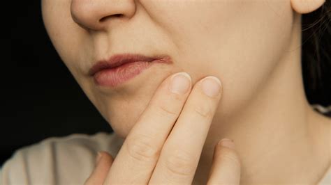 Angular Cheilitis Causes Symptoms Treatment