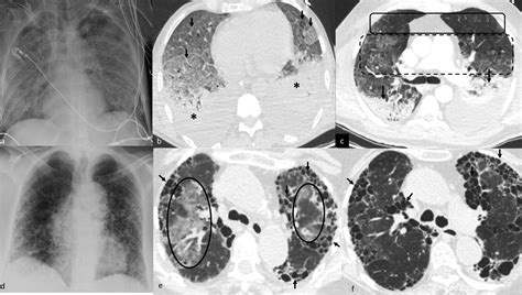 Schematic Approach To The Diagnosis Of Multifocal Lung Opacities In The