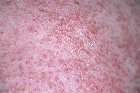 Pityriasis Rubra Pilaris Stock Image C0430691 Science Photo Library