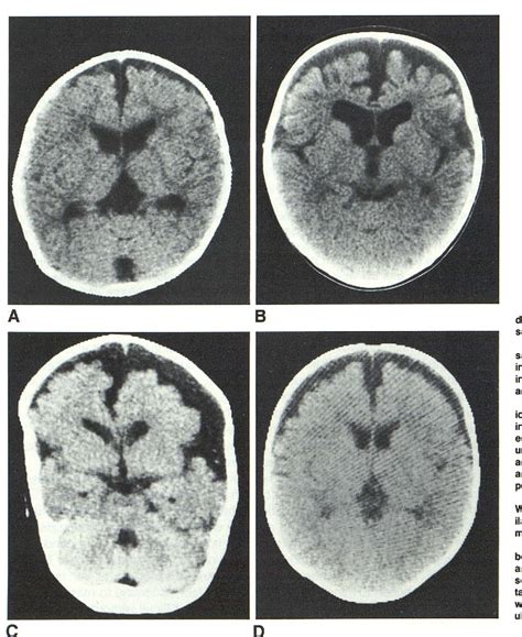 Figure 1 From And Differentiation From Cerebral Atrophy External