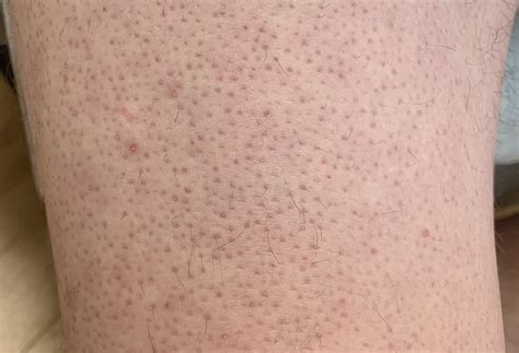 Keratosis Pilaris Legs