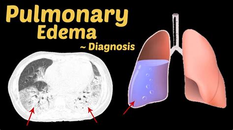 Pulmonary Edema Diagnosis Ct Scan Chest Radiology Youtube