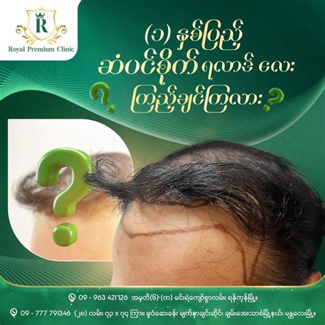 မန္တလေးမှာဆံပင်စိုက်ပါ ကဲဒီပုံမှာ ဆံပင်စိုက်ထားတဲ့သူရဲ့ ၁ နှစ်ပြည့်ရလဒ်ကြည့်ချင်ရင် ဝင် ဖြေသ