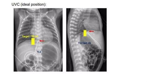 Neonatal Chest X Ray Pptx
